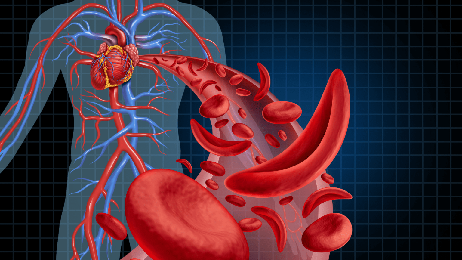 Você já ouviu falar na anemia falciforme?